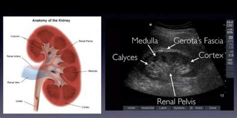 Renal Ultrasound Made Easy Step By Step Guide Artofit