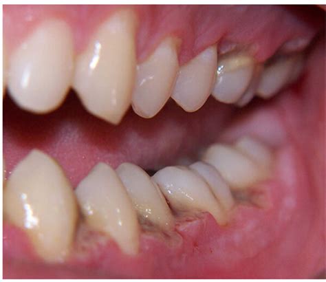 Necrotizing Ulcerative Gingivitis Note The Characteristic Gingival