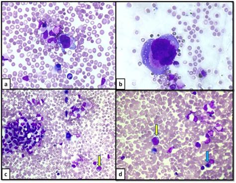 Ascitic Fluid Cytology Ab Singly Scattered Large Cells With Round To