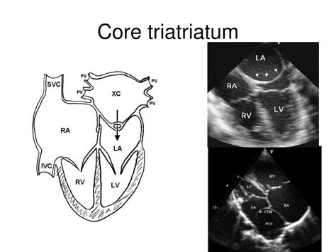 Ppt Congenital Heart Defects Functional Overview Powerpoint