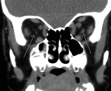 Anomalous Extraocular Muscles With Strabismus Pmc