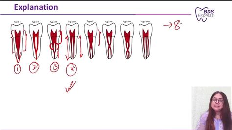 Neet Mds 2024 Endo Vertucci Classification Youtube