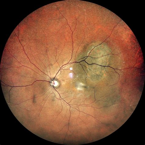 Choroidal Melanoma Retina Image Bank