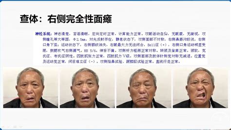 李世亭教授团队：颅底肿瘤手术中颅神经保护与功能重建 脑医汇