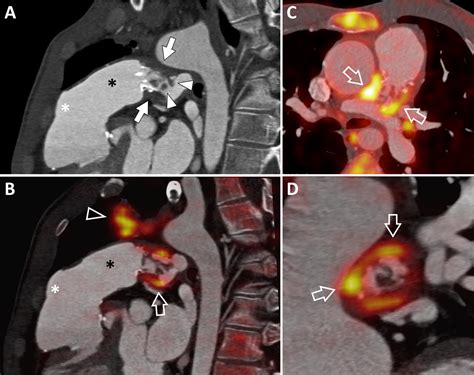 Right Sided Endocarditis On Contegra Tube In A Complex Cianotic