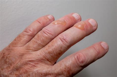 Premium Photo Typical Blisters On The Skin From Seconddegree Burning