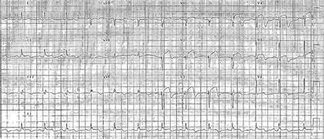 Ecg Of Anterior Wall Stemi With Fragmented Qrs In Inferior Leads Ii