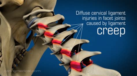 Cervical Neck Instability Degenerative Cervical Disc Disease And