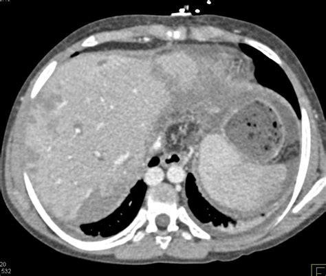 Active Bleed Adjacent To The Liver Liver Radiology Case Studies