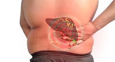 Ascitis Benigna Conociendo Sus Tipos Y Grados Doctor Online