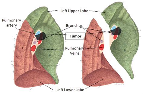 Lung Parenchyma Definition Lung Parenchyma Flashcards Quizlet Check