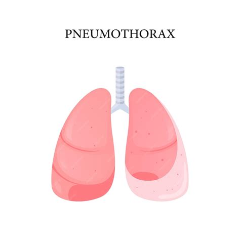 Premium Vector Pneumothorax Disease Vector Illustration Design For