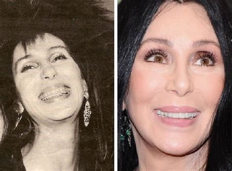 Cher Before And After Plastic Surgery Boob Nose Face Teeth