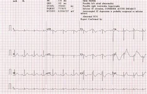 Ekg Reads As Acute Stemi Any Thoughts Rreadmyecg