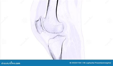 Ct Scan Of Knee Joint For Medical Background Stock Illustration