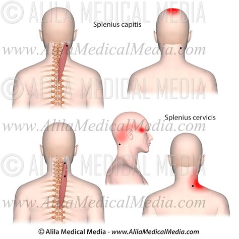 Splenius Capitis Trigger Point