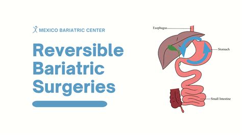 Which Bariatric Surgery Is Reversible Wylc