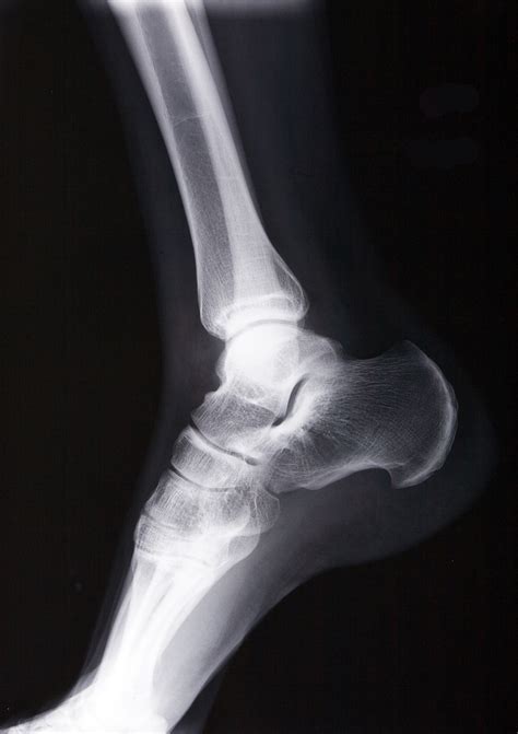 Pointe Shoes Xray At Erwin Marlatt Blog