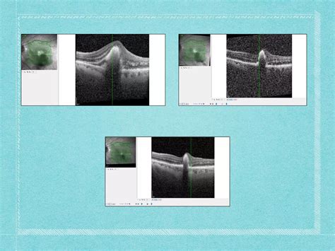 Retinal Artery Macroaneurysmpptx