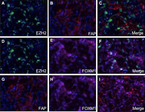 Mif Images Showed The Colocalization Of Ezh2 Foxm1 And Fap In Gc
