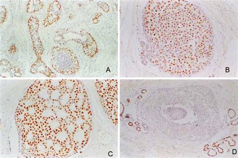 Expression Of Er In Precancerous Lesions Of Breast A Er Cells In A