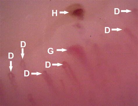 Scleroderma Type Capillaroscopic Pattern An Early Phase D Dilated