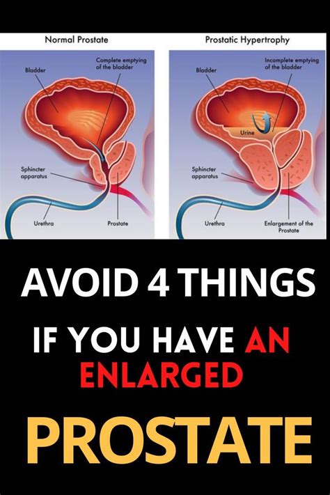 Prostate Cancer Prevention Benign Prostatic Hyperplasia Urinary