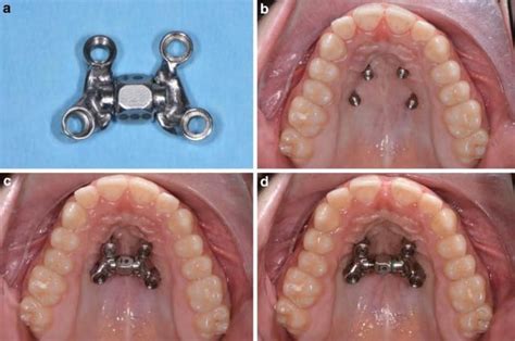 Sarpe Surgery Story Recovery And Procedure R Jawsurgery