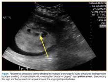Diagnosis At A Glance Partial Hydatidiform Molar Pregnancy Mdedge