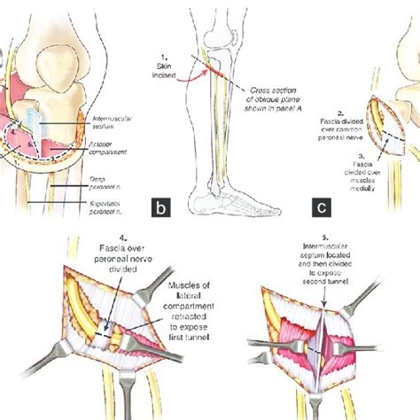 Illustration Shows Device For The Measurement Of Nerve Rigidity Inset