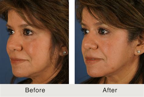 Juvederm In Charlotte Nc Carolina Facial Plastics