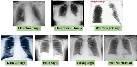 Chest X Ray Pulmonary Embolism