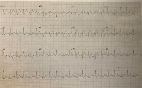 Increasing St Segment Elevations In Leads V1 And V2 New St Segment Download Scientific Diagram
