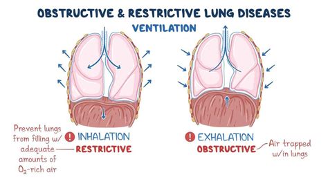Obstructive Vs Restrictive Pulmonary Disease Video Causes And Meaning Osmosis