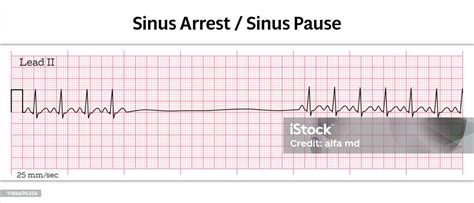 Ekg Sinus Arrest Sinus Pause 8 Kertas Elektrokardiogram Detik Ilustrasi