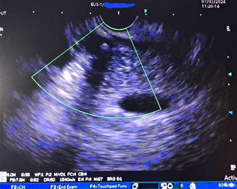 Radhika Nittala On Linkedin Eus Ercp