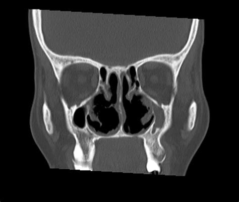 Atrophic Rhinitis