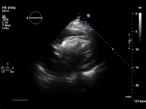 Pericarditis Echo