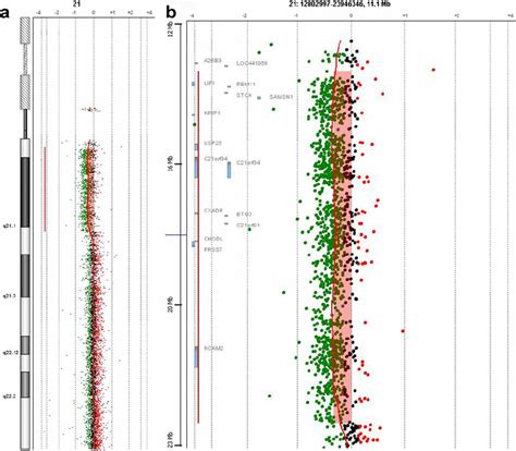 Array Cgh Analysis Of The Patient S Dna A Chromosome View Showing