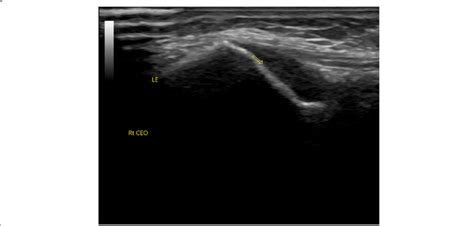 Us Picture Showing Disturbed Fibrillar Pattern Of Rt Ceo Tendon Of A Download Scientific