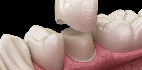 Understanding Zirconium Crown Benefits And Applications