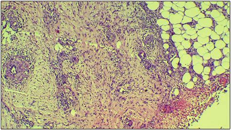 Nodular Vasculitis Showing Presence Of Involvement Of Thick Walled