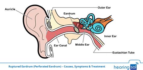 Ruptured Eardrum Perforated Eardrum Know Best Treatment