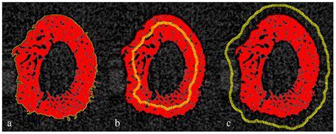 The Bone To Soft Tissue Interface Is Outlined In Yellow In A The
