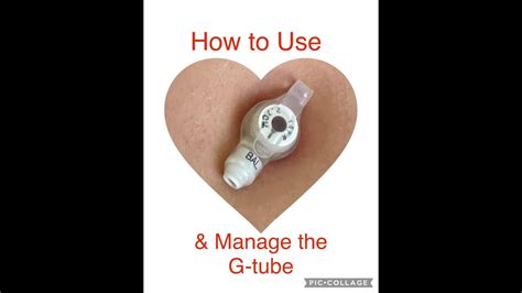 How Long Does It Take To Remove A G Tube At Naomi Marshall Blog