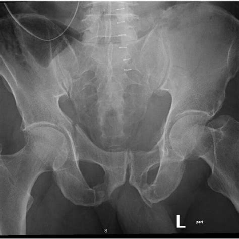 Anterior Posterior View Demonstrating Right Transverse Acetabulum
