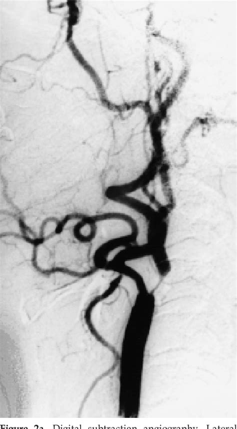 [pdf] Cerebral Hyperperfusion Syndrome After Carotid Angioplasty