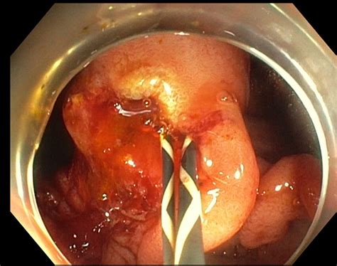 Biliary Sphincterotomy Download Scientific Diagram