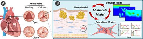 A Schematic Comparison Between A Healthy Aortic Valve And A Calcified