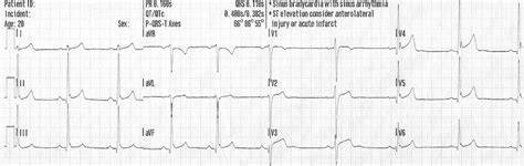 Repolarization Ecg